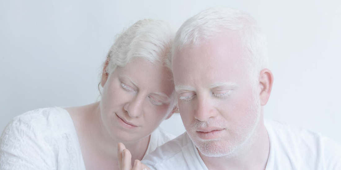 Albinos Causas Del Albinismo Problemas De Salud Y Sociales | My XXX Hot ...